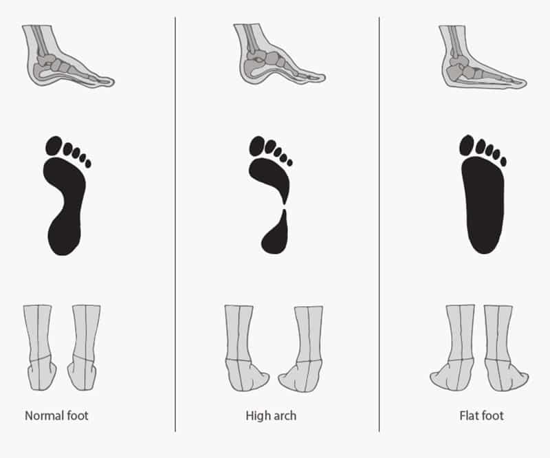 Flat Feet | Brooklin Foot & Orthotic Clinic